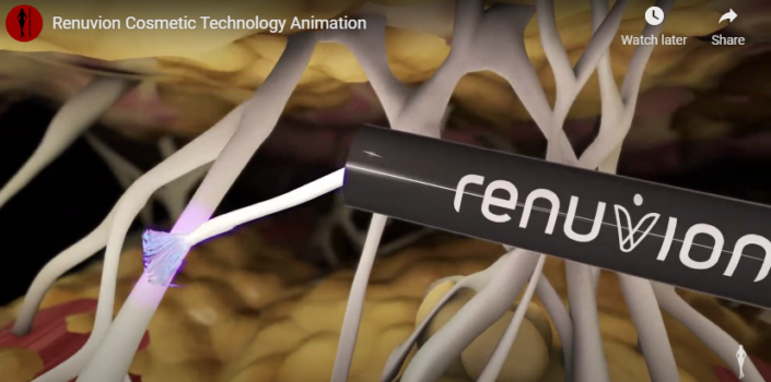 Renuvion: treatment of sagging skin without surgery