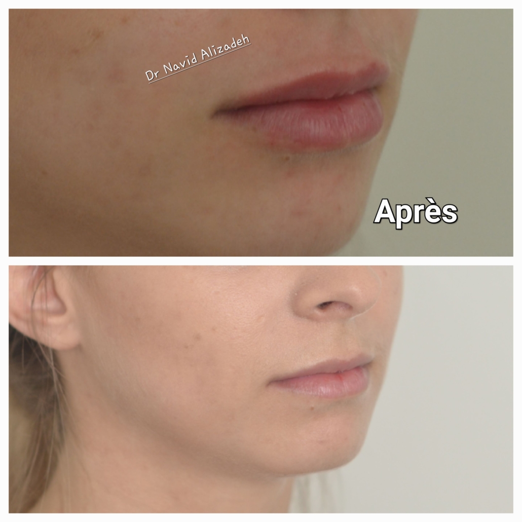 Injection d'acide hyaluronique lèvres: aspect subtil et harmonieux