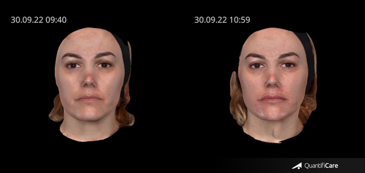 Softlift full face subtil et naturel à des injections d'acide ...